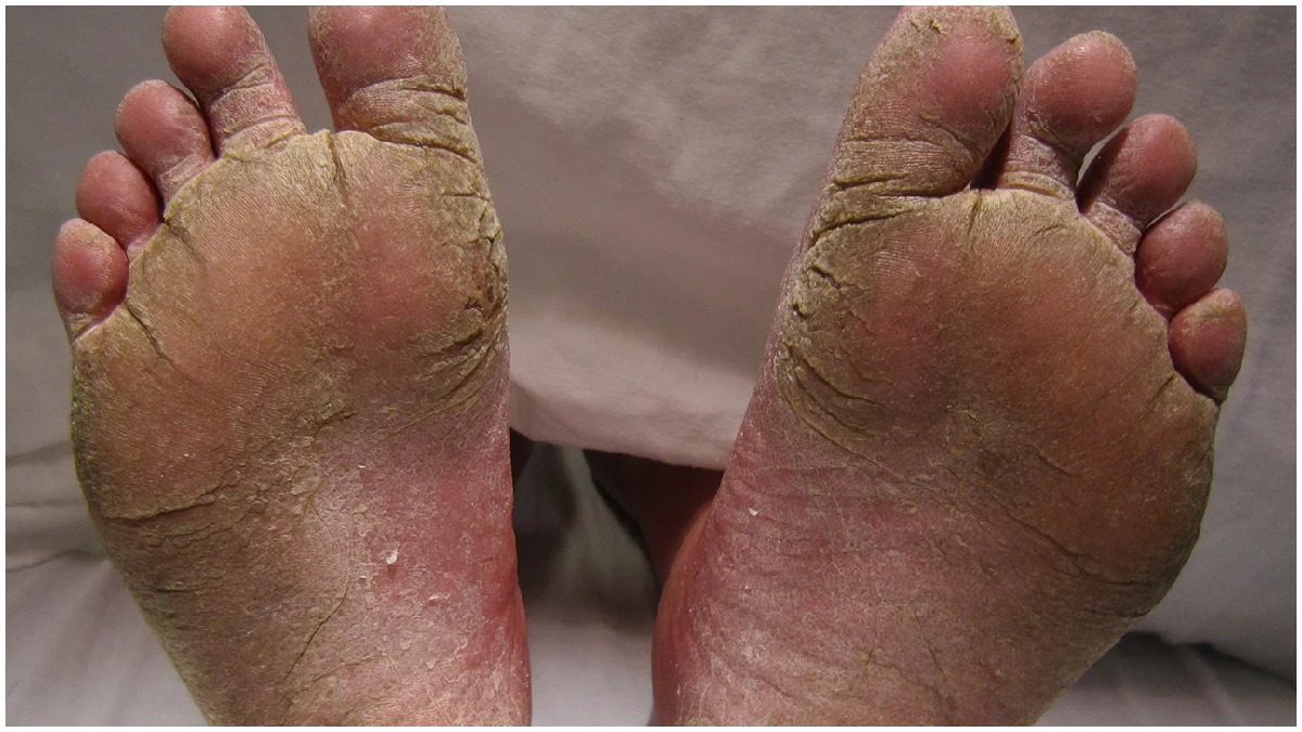 పాదాలు పగులుతుంటే ఇలా చేయండి | feet cracks reduce health tips details ...